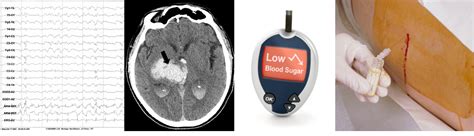 Acute Coma Approach To Diagnosis And Management Recapem