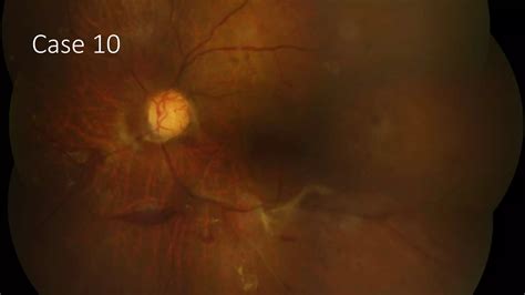 Post Test Detection Of Diabetic Retinopathy Using Fundus Photos Online Quiz Ppt
