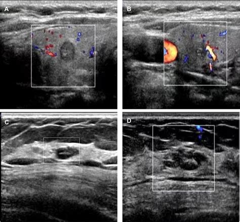 Thyroid Ultrasound And Breast Ultrasound A Preoperative Thyroid Download Scientific Diagram