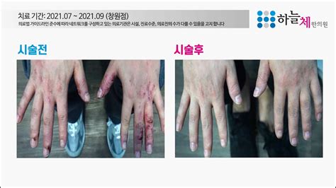 손 건선 치료 전후 사진 Youtube