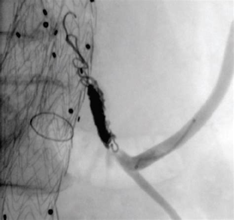 Ruby Coil And Pod System Tools For Dense And Durable Embolisation Endovascular Today
