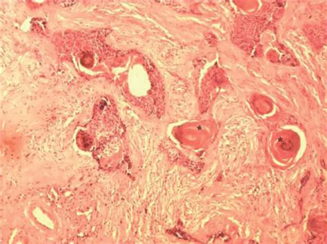 A Photomicrograph Of Orbit With Well Differentiated Squamous Cell