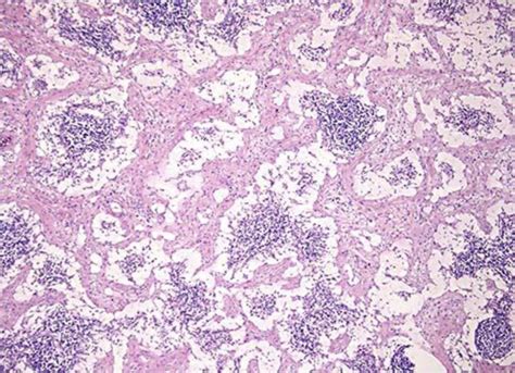 Histological Section With He Staining Of The Resected Myofibroblastic