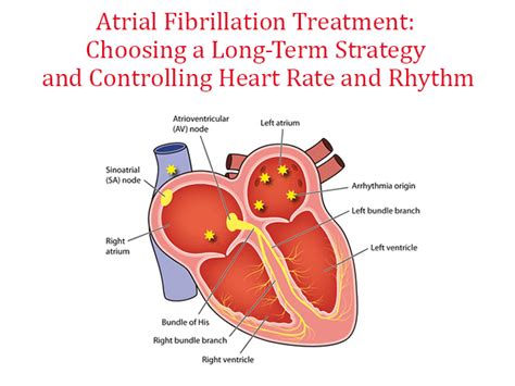 Atrial Fibrillation Treatment Afib Treatment Dr C Raghu