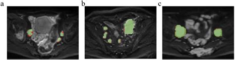 Figure 3 From Development And External Validation Of The 3d U Net