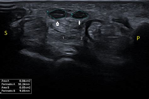Bifid Median Nerve With Persistent Median Artery In Carpal Tunnel Syndrome Assessment With Us