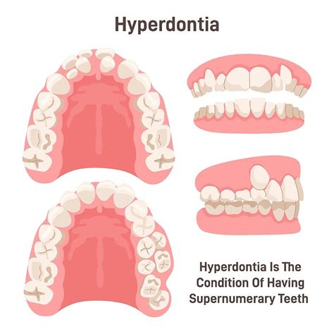 Supernumerary Teeth Mesiodens