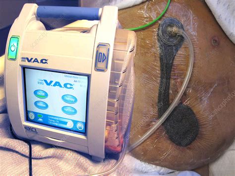 Parts Of A Wound Vac At Betty Fitzpatrick Blog