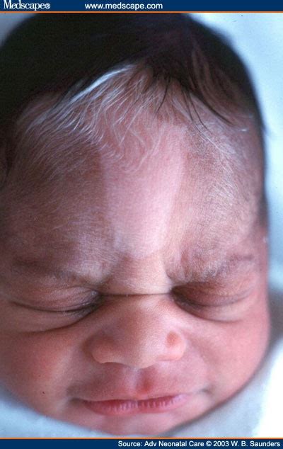 Scalp Hair Characteristics In The Newborn Infant Page 6