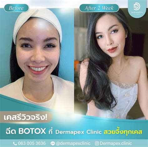 Dermapex Clinic รักษาสิว งานผิว ปรับรูปหน้า ทำทุกหัตถการโดยแพทย์ที่มีประสบการณ์ด้านความงาม