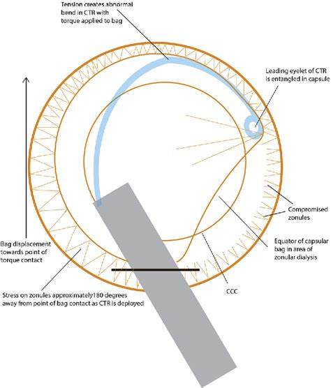 Figure 2 From Suture Guided Capsular Tension Ring Insertion To Reduce