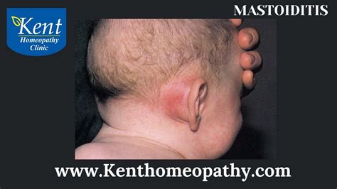 Mastoiditis Kenthomoepathy Powai Mumbai Homeopathy Doctor