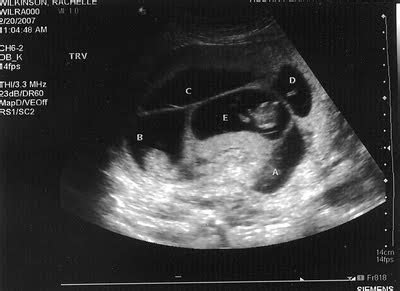 Quintuplets Ultrasound