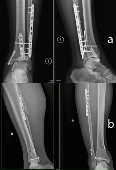 Two Patients Underwent Both Posterior Malleolar Fragment And Download Scientific Diagram