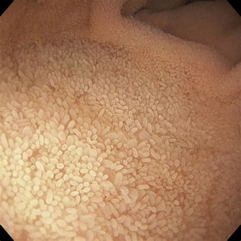 The Appendix Orifice Seen Underwater The Cecum Is Thoroughly Cleaned