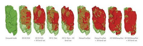 Qualitative Comparison Of Colorectal Tumor Segmentation Results Download Scientific Diagram