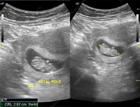 Week By Week Fetal Ultrasound