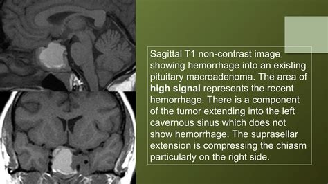 Pituitary Gland Mri Pptx