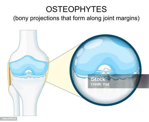 Osteophyte Anatomy Of Human Knee Joint Osteoarthritis向量圖形及更多人關節圖片 Istock