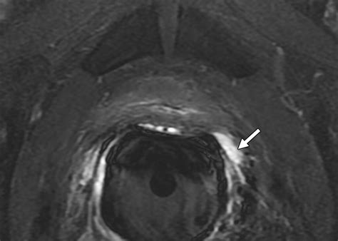 Detection Of Local Recurrence Of Prostate Cancer After Radical