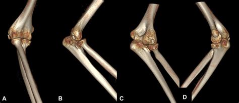 A And B Ct Image Of Bone Component Or Heterotopic Ossification Near