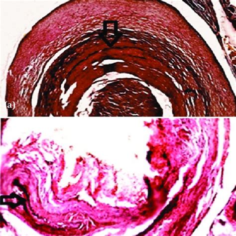 Ab Avm Elastic Stain Highlights The Disruption Of Elastic Lamina