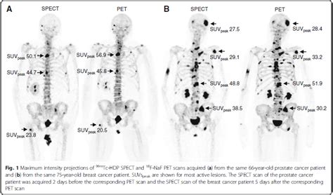 Hermia Spect Hermes Medical Solutions