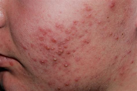 Understanding Different Stages Of Acne Mild Moderate And Severe