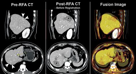 Safety Margin Assessment After Radiofrequency Ablation Of The Liver Using Registration Of
