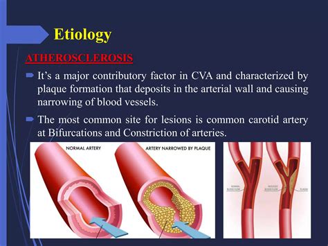 Stroke Cva Cva Cerebrovascular Accident Transient Ischemic Attack Ppt Stroke Cva Cva Cerebrovascular Accident Transient Ischemic Attack Ppt