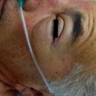 Bilateral Erythematous Poorly Delineated Plaques Of Different Shapes Download Scientific