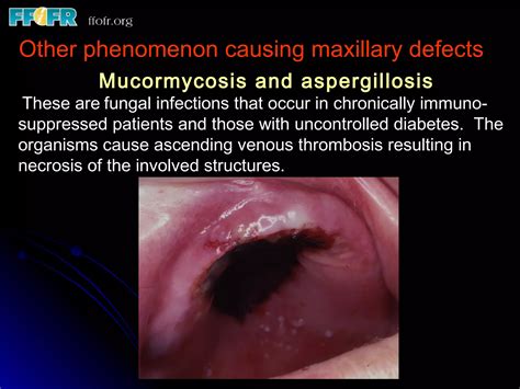 10 Etiology Of Palatal And Paranasal Sinus Defects Ppt Ear Nose And Throat Conditions