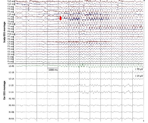 Comparison Of Full Scalp EEG And Ear EEG Montage Showing The Onset Of Download Scientific