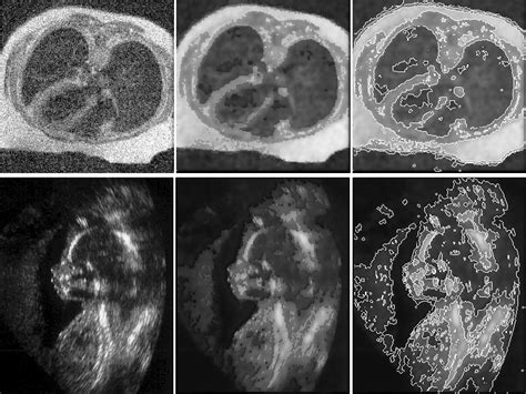 Segmentation And Smoothing Of Noisy Medical Images Left Column Top Download Scientific