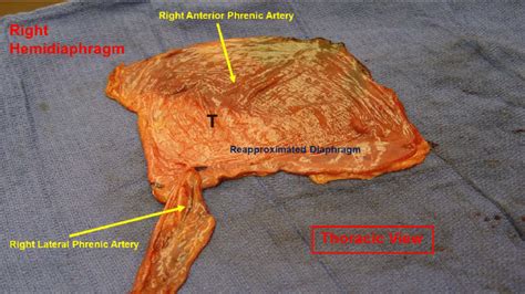 Thoracic View Of The Right Hemidiaphragm Excised From A Cadaver The