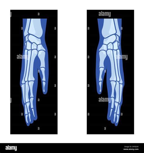 Blak Ulna Bone Diagram