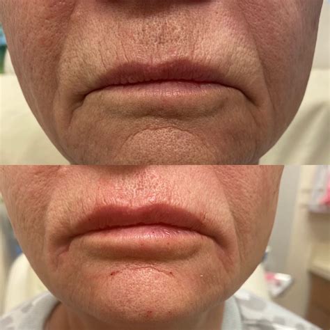 Upper Lip Botox Before And After