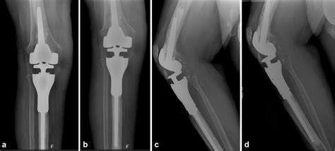 Proximal Tibial Replacement In Revision Knee Arthroplasty For Non Oncologic Indications Pmc