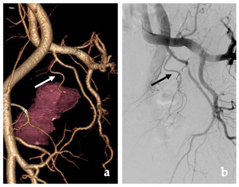 Prostate Artery Embolization—review Of Indications Patient Selection