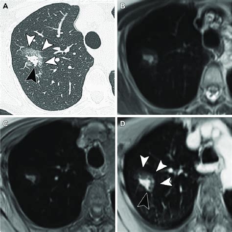 Representative Images In Axial Plane Of A Part Solid Nodule At Download Scientific Diagram