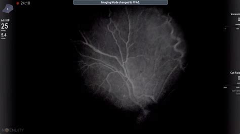 3d Intraoperative Angioscopy Eyetube