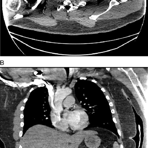 Ct Chest With Contrast Showed An Enlarged Right Lobe Thyroid Gland With Download Scientific