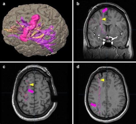 fiber tractography of lead 0 in patient 3 gpi dbs three dimensional