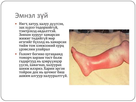 арьсны идээт өвчнүүд Pptx