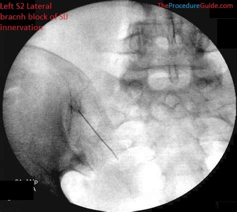 Sacroiliac Joint Injection Technique
