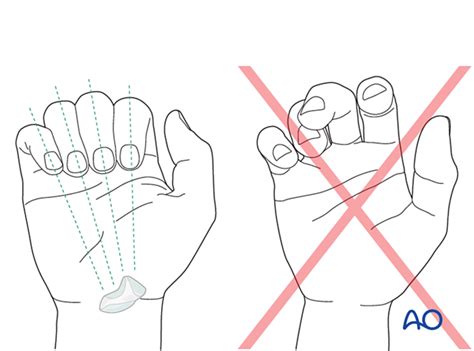 Lag Screw Fixation With A Neutralization Plate For Simple Oblique Fracture Of The Diaphysis