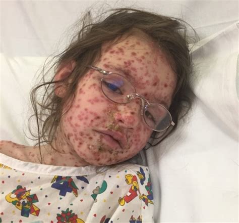 Girl 5 Struck Down With Worst Chicken Pox Doctors Had Ever Seen