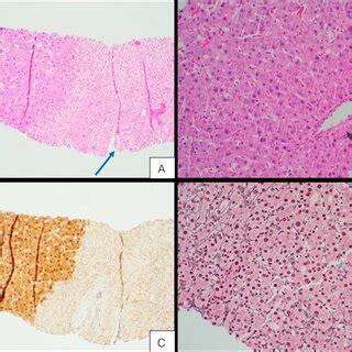 A A Well Defined Border Between The Lesion Black Arrow And The Download Scientific Diagram