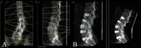 Figure 1 From Preoperative Robotics Planning Facilitates Complex Construct Design In Robot