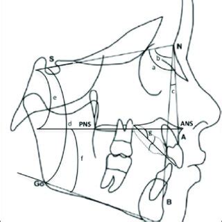 Parameters Measured On The Lateral Cephalometric Radiography A Sna